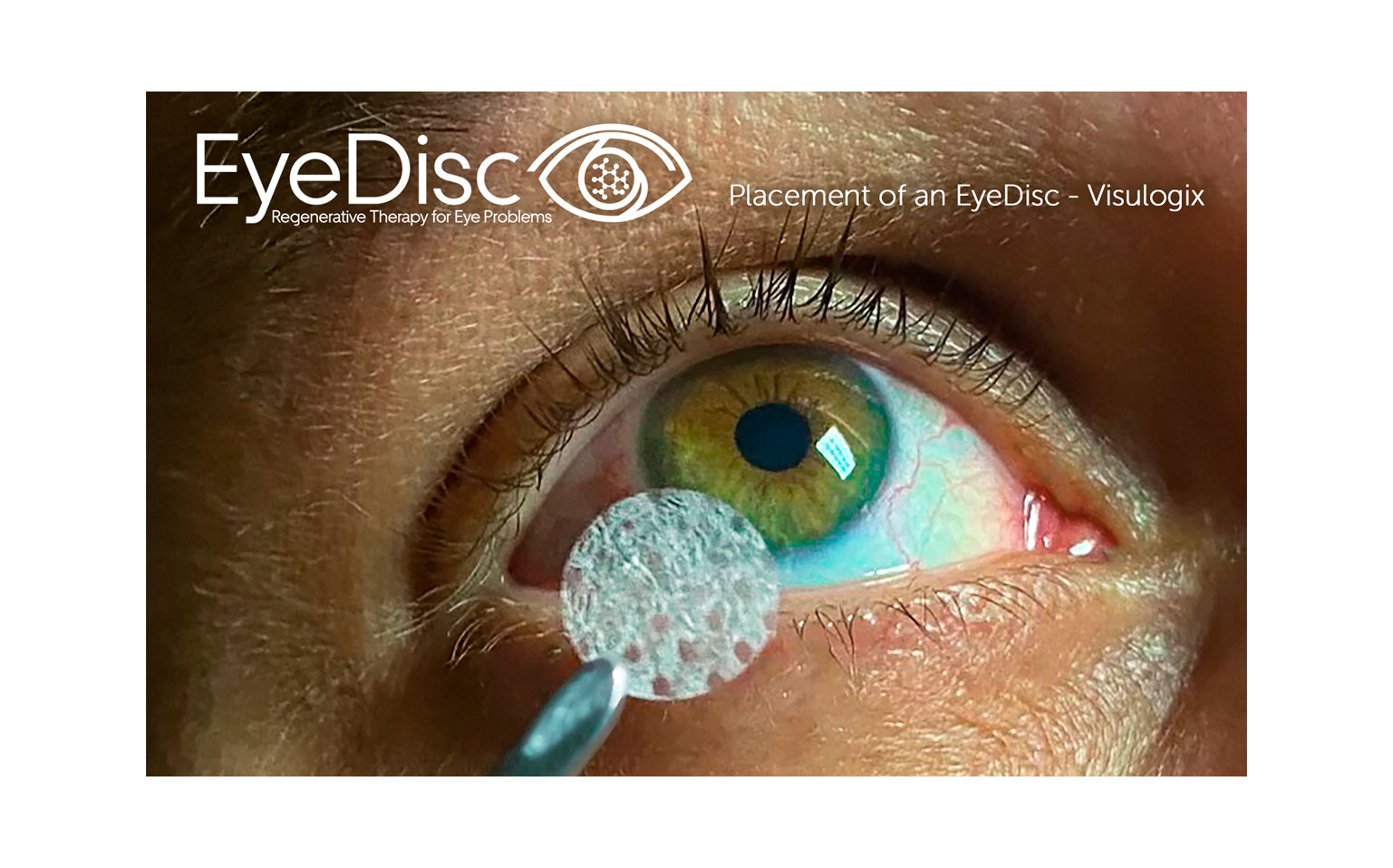 Resources – EyeDisc